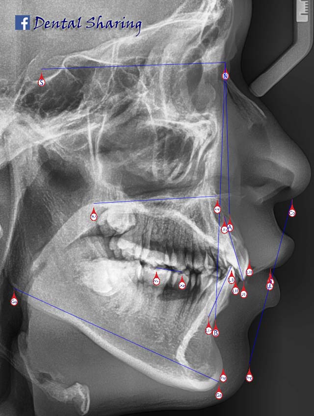 (y) PHÂN TÍCH STEINER - Dr. Răng Hàm Nhỏ