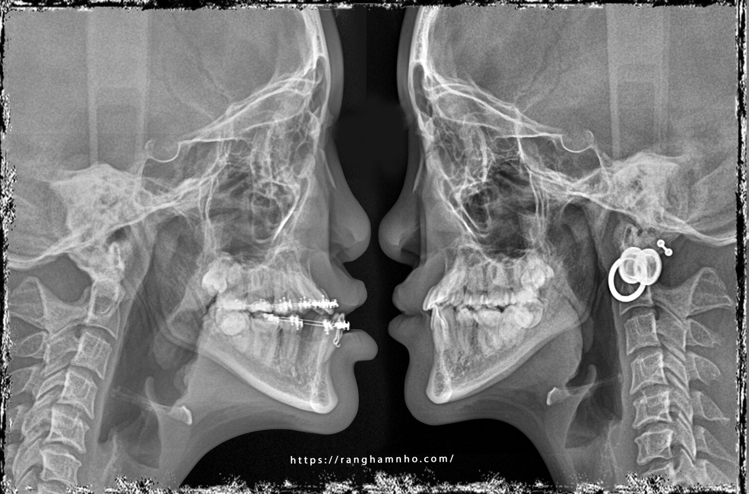 Dang Phuong Lan_2000: Class III/ Cleft lip and cleft palate. RPE ...