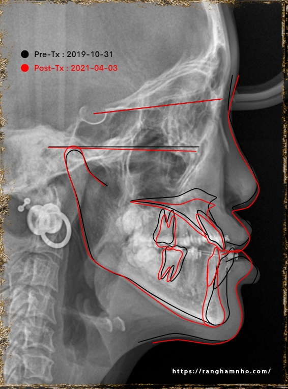 Dang Phuong Lan_2000: Class III/ Cleft lip and cleft palate. RPE ...